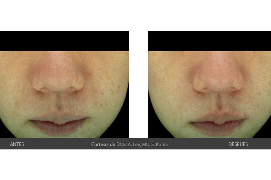 Spectra XT :: Lutronic